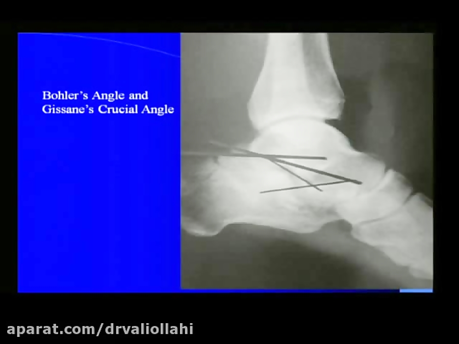 Calcaneus Fracture Fixation- Assesment, Treatment, and