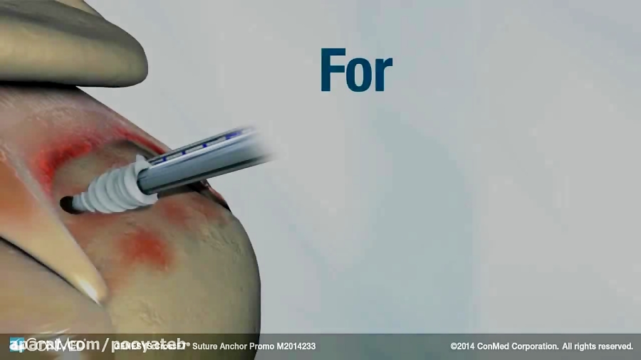GENESYS CrossFT® Suture Anchor - ConMed Product Video