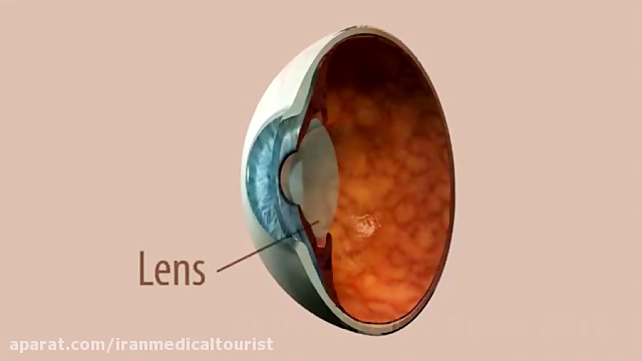 Phacoemulsification Cataract Surgery