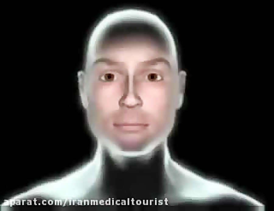 3D Lasik Eye Surgery Animation