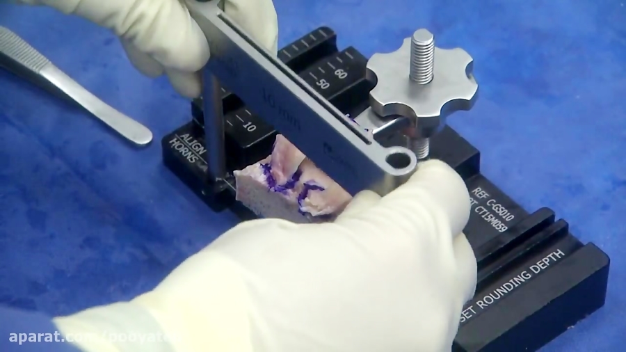 Dr. David Flanigan - Meniscus Allograft Transplant - CONMED Surgical ...