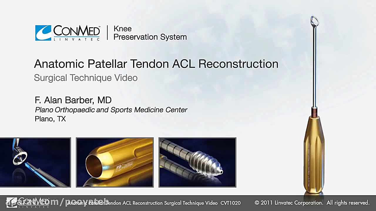 Dr. Alan Barber - Anatomic Patellar Tendon ACL Reconstruction - ConMed