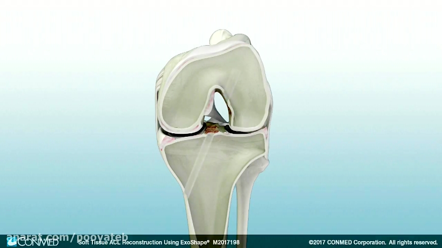 Soft Tissue ACL Reconstruction Using ExoShape® - CONMED Animation