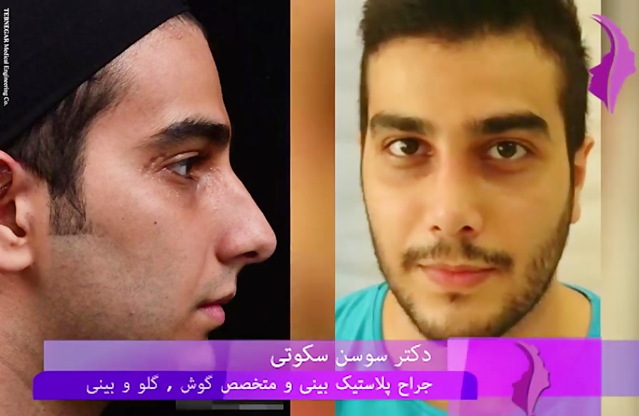 قبل و بعد از جراحی بینی