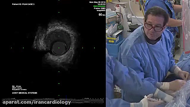 Three Vessel PCI Versus Bypass Surgery Reduced to One Vessel PCI