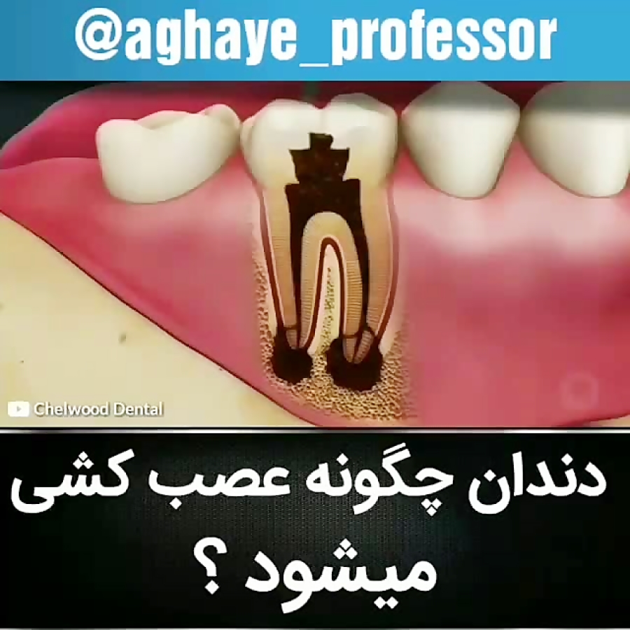 عصب کشی دندان