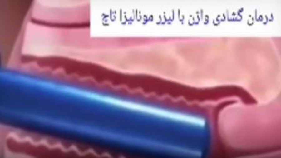 درمان گشادی واژن با لیزر مونالیز تاچ