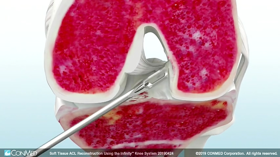 Soft Tissue ACL Reconstruction Using the Infinity™ System - CONMED ...