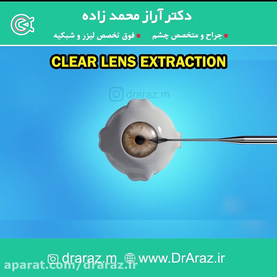 clear lenz extraction