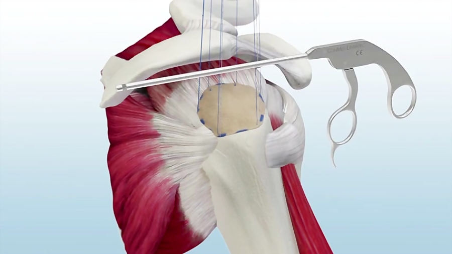 Double Row Rotator Cuff Augmentation Using Y-Knot® Rc, Allopatch Hd®