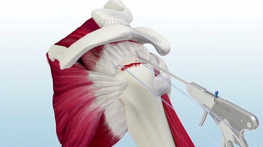 Double Row Rotator Cuff Augmentation Using Y-Knot® RC, Allopatch HD ...