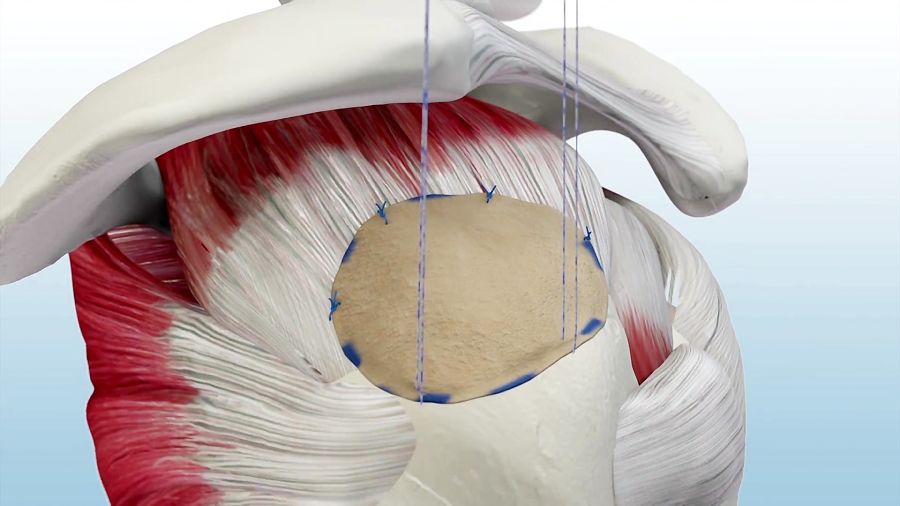 Single Row Rotator Cuff Augmentation Using GENESYS CrossFT®, Allopatch HD