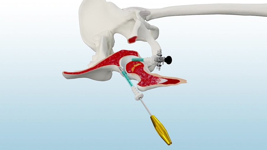 FAI with Labral Repair Using the Paradigm™ Hip System