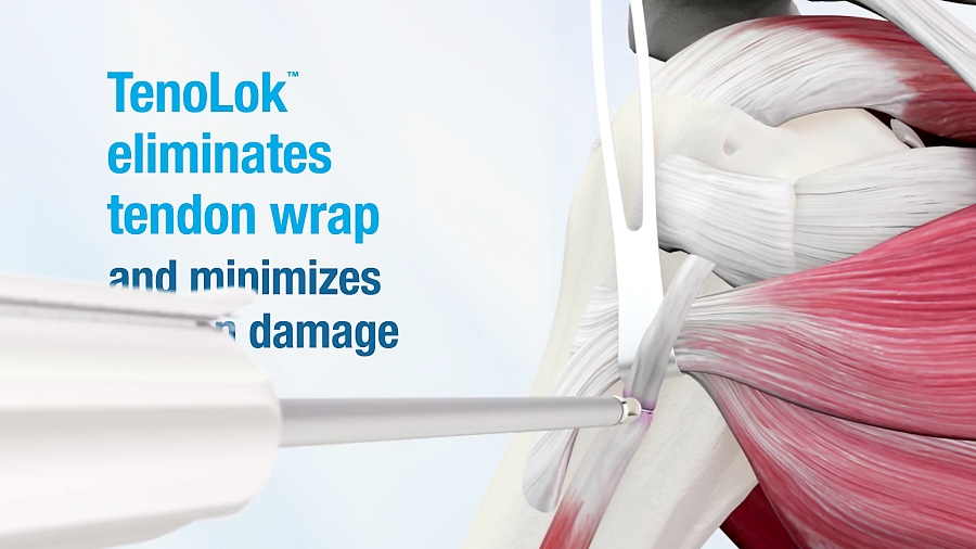 TenoLok™ Tenodesis Anchor - Product Video