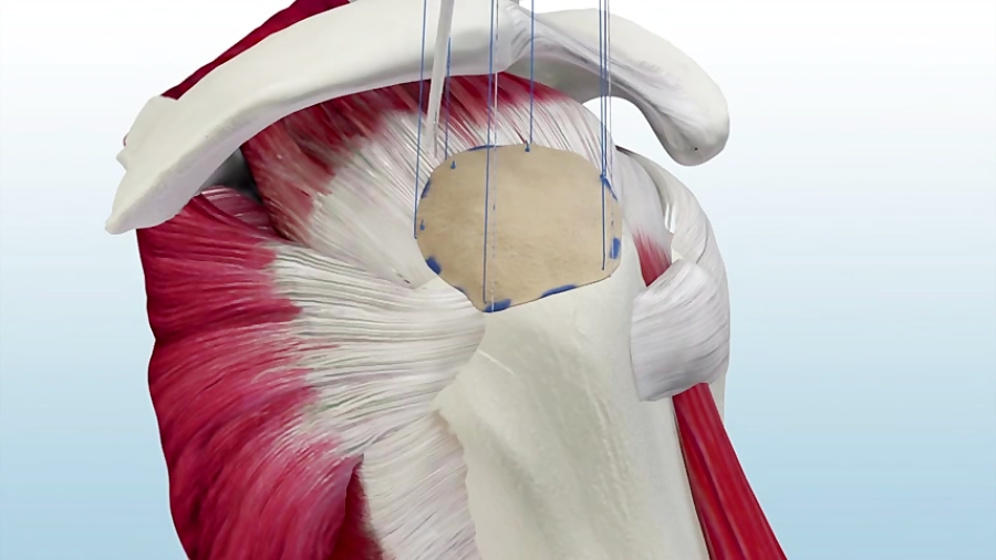 Double Row Rotator Cuff Augmentation Using Y-Knot® RC