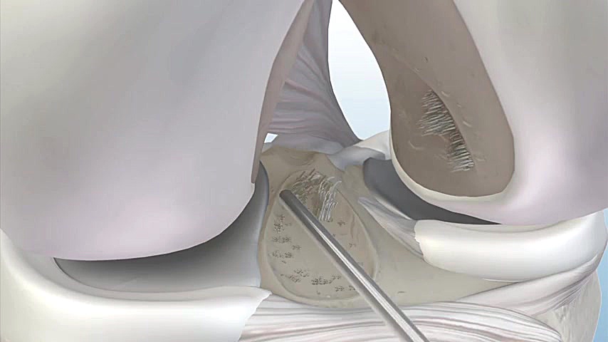 Curved Anatomic BTB ACL Reconstruction Using the GraftMax™ System