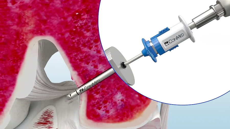 All-Inside ACL Reconstruction Using the Infinity™ Knee System