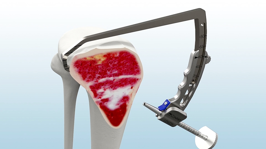 PCL Reconstruction Using the Infinity™ Knee System