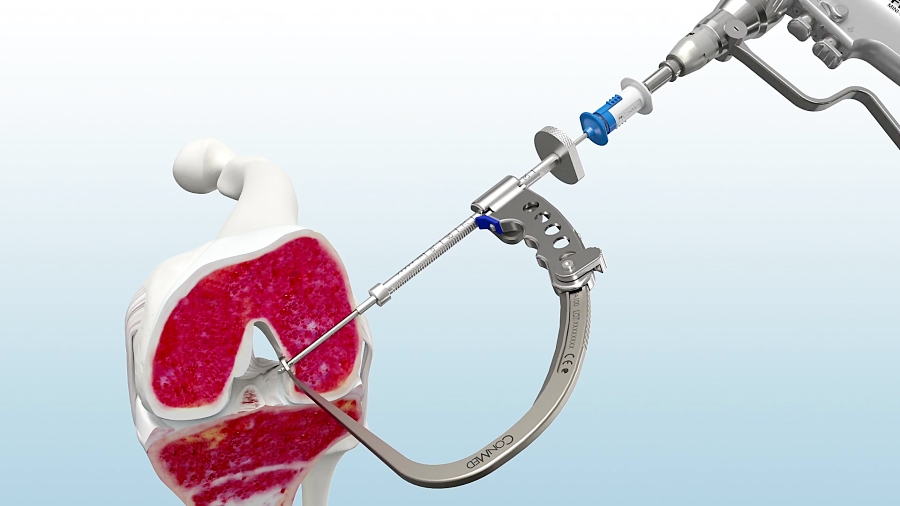 All-Inside ACL Reconstruction Using the Infinity™ Knee System