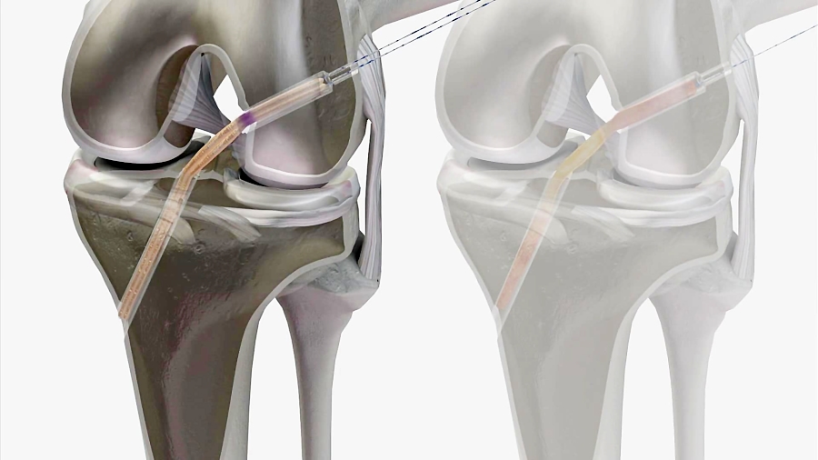 Curved Anatomic Soft Tissue ACL Reconstruction Using XO Button