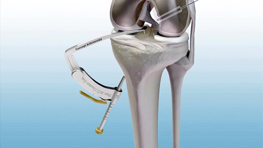 Curved Anatomic BTB ACL Reconstruction Using GENESYS Matryx