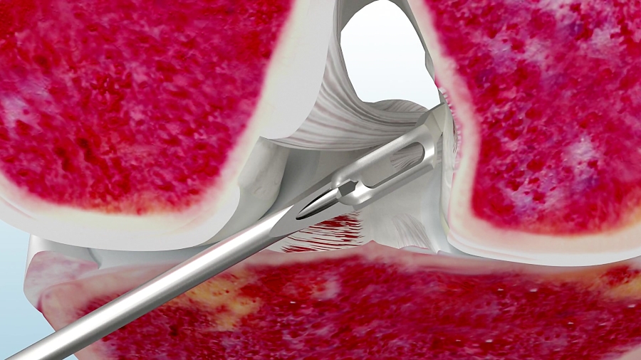 Soft Tissue ACL Reconstruction Using the Infinity Knee System