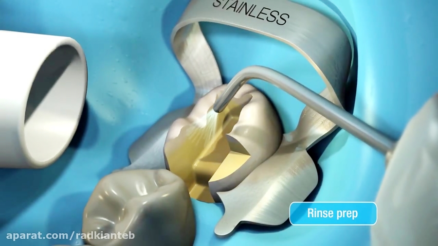 کامپوزیت بالک فیل پارکل با نام HyperFil