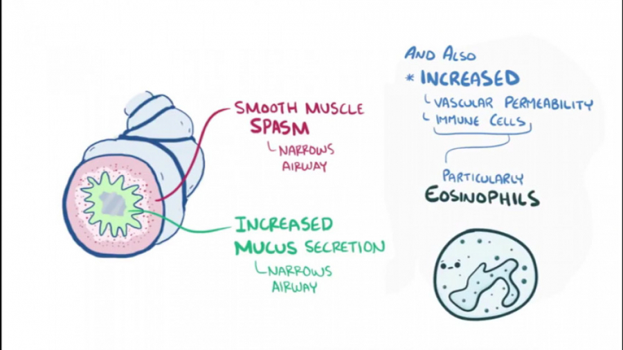 Pleural Friction Rub