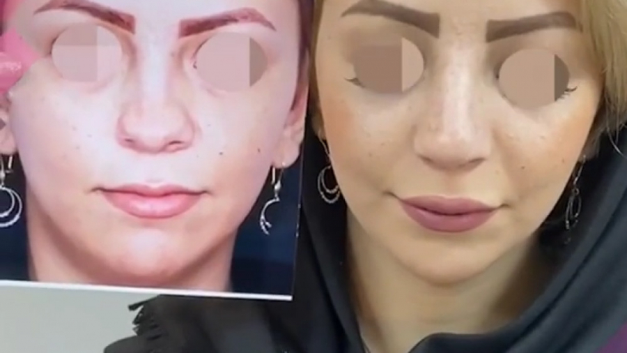 ده روز بعد از جراحی بینی