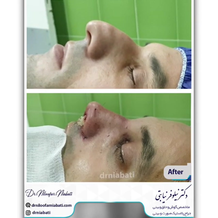 قبل و بعد از جراحی بینی