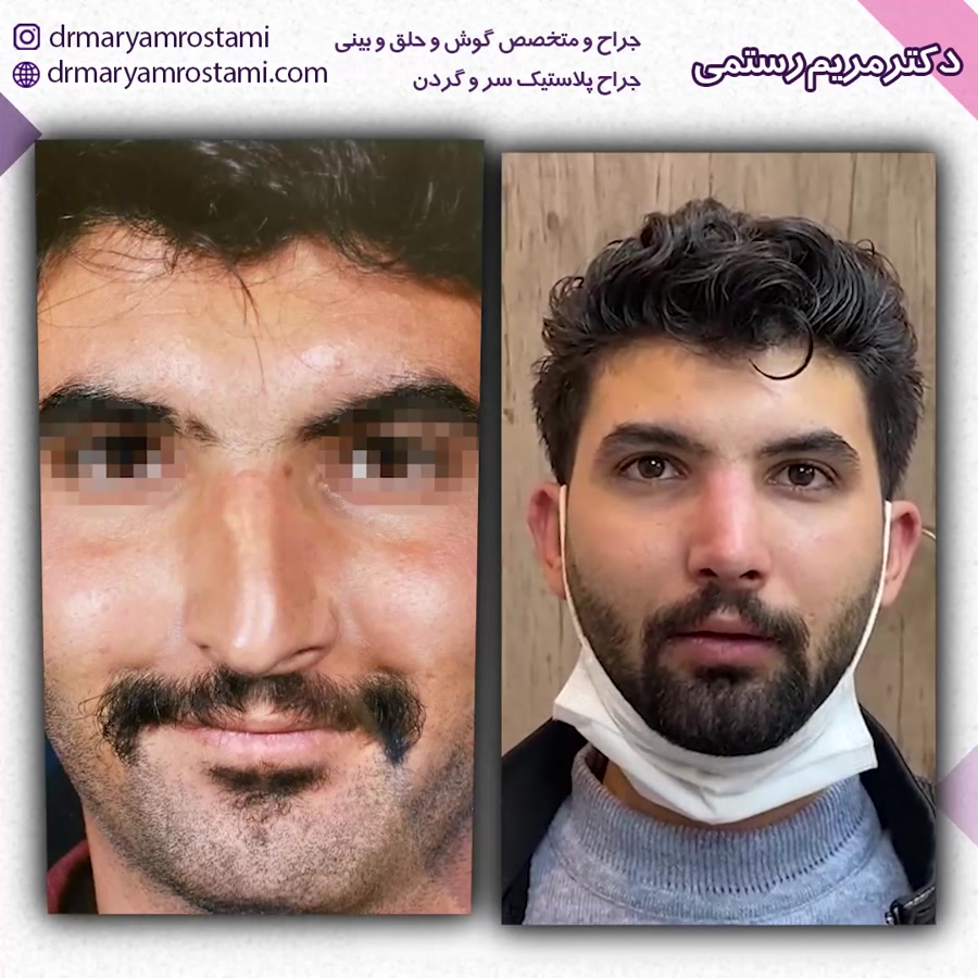 دو ماه بعد از جراحی زیبایی بینی