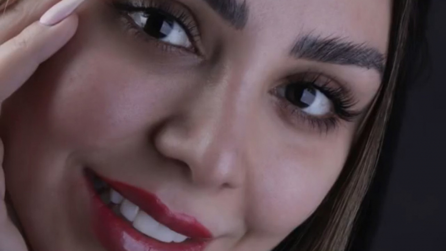 کامپوزیت دندان در اصفهان سفید طبیعی