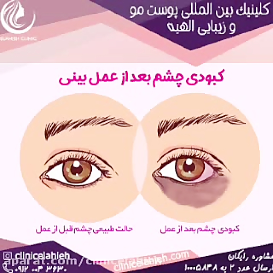علت پف چشم بعد از جراحی بینی