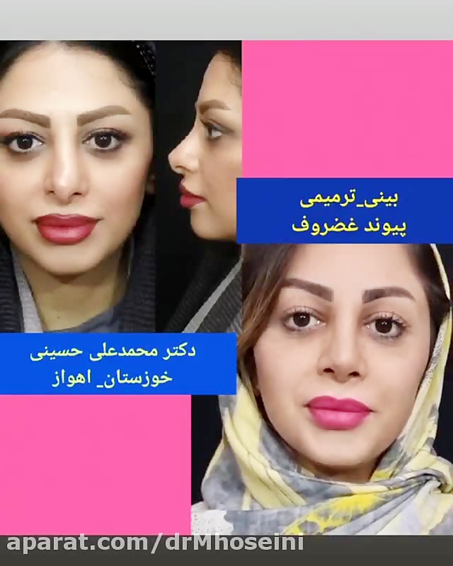 جراحی ترمیمی بینی پیوند غضروف