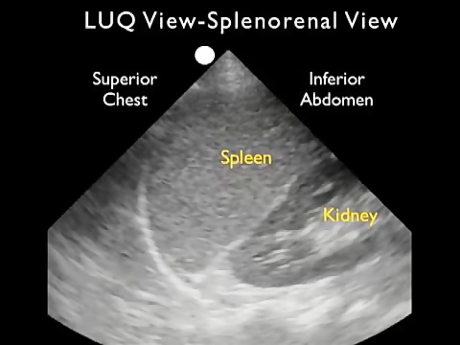ارزیابی تروما با سونوگرافی (FAST Exam) - آزمون LUQ