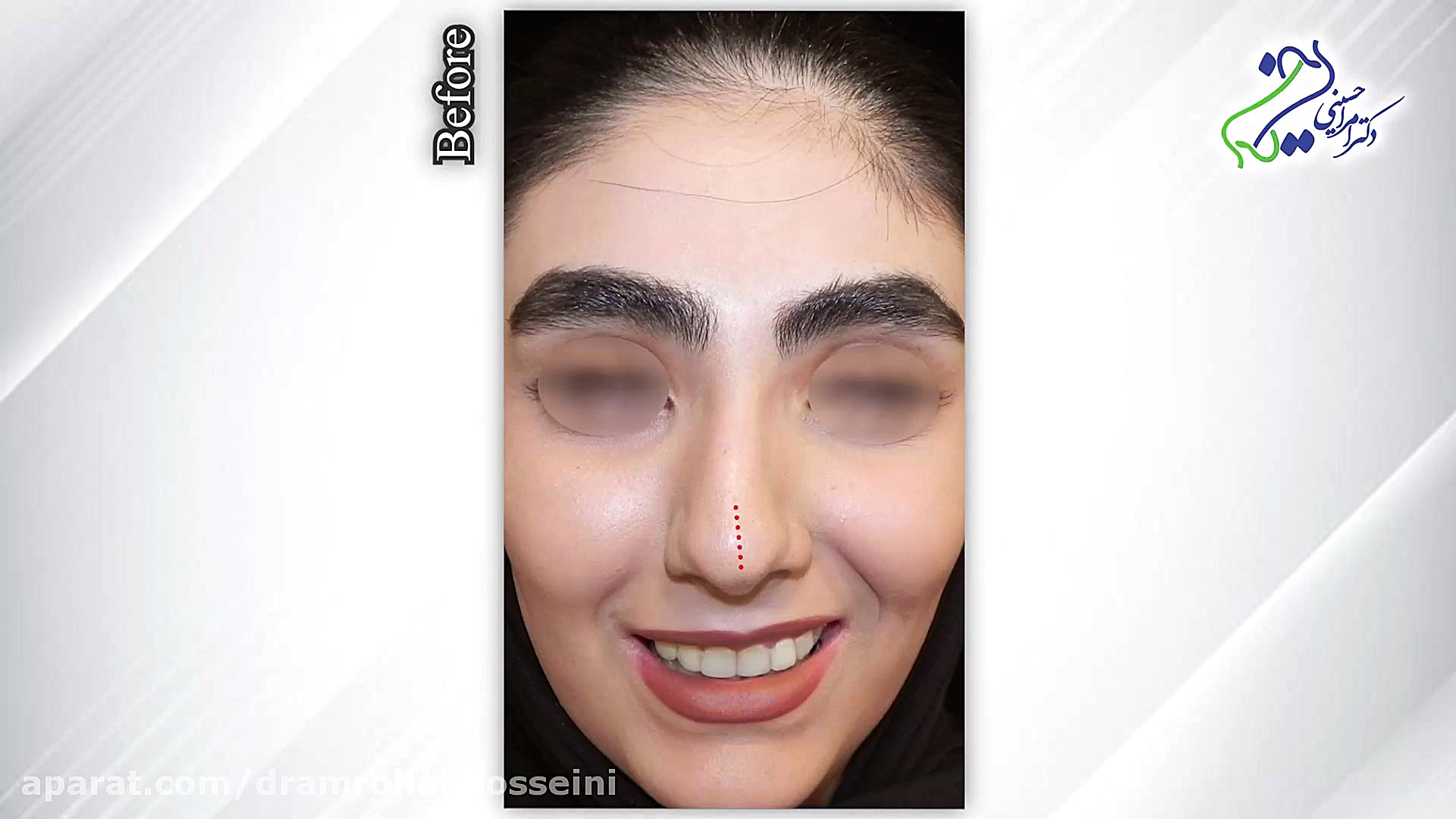 یکسال پس از عمل زیبایی بینی