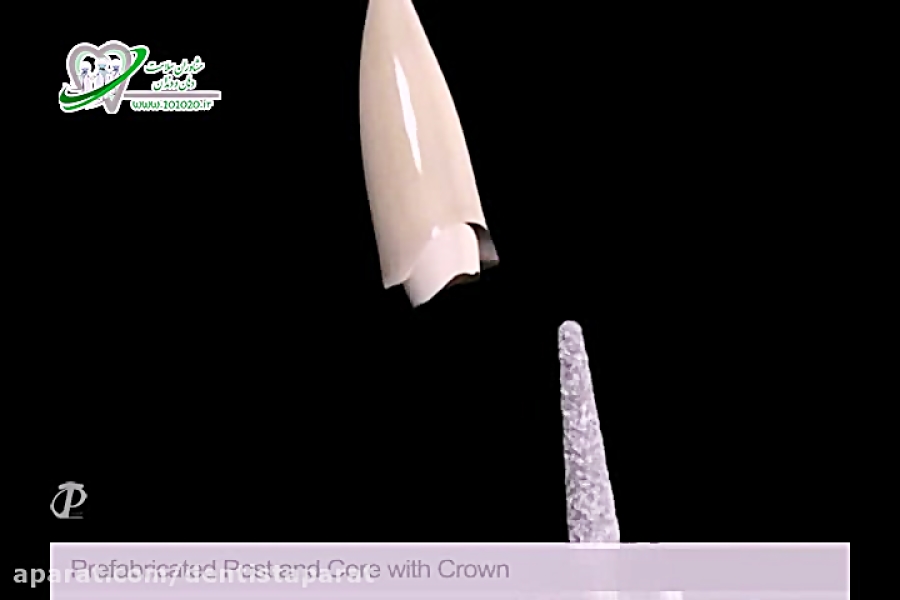 - ترمیم prefabricated post and core with crown