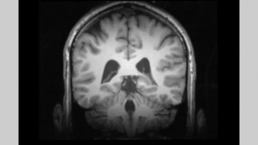 Image Processing and brain Magnetic Resonance Imaging_MRI(2)