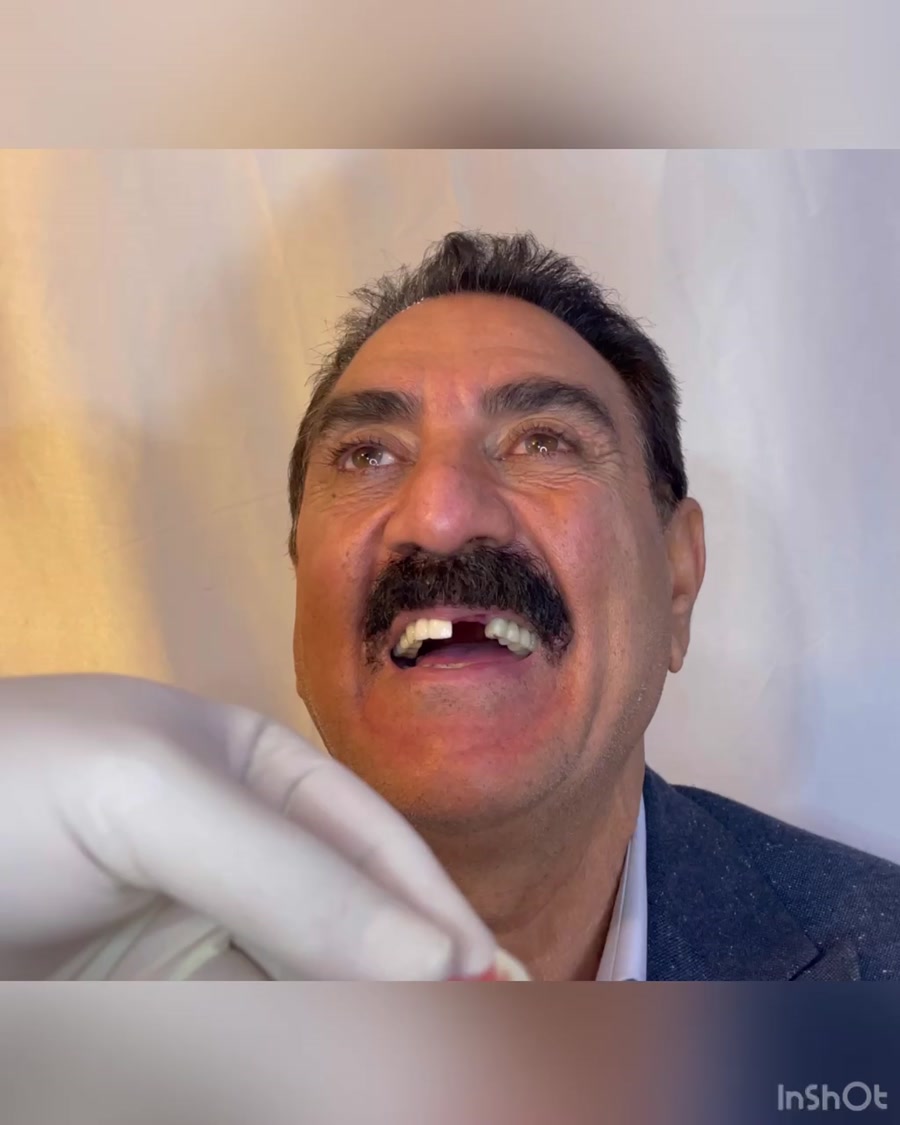 ساخت پروتز فلیپر دو دندانی در لابراتوار دندانسازی تاج دندان