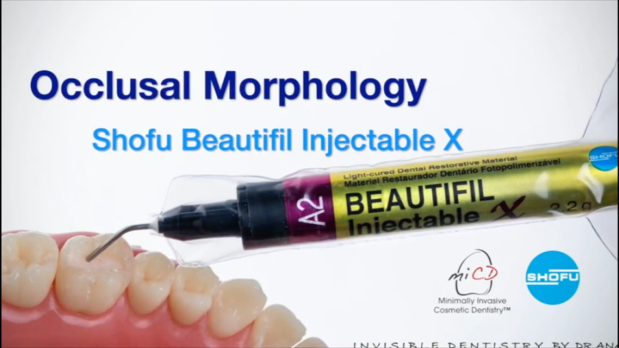 مورفولوژی اکلوزال با استفاده از کامپوزیت‌های شوفو Beatifil Injectable X