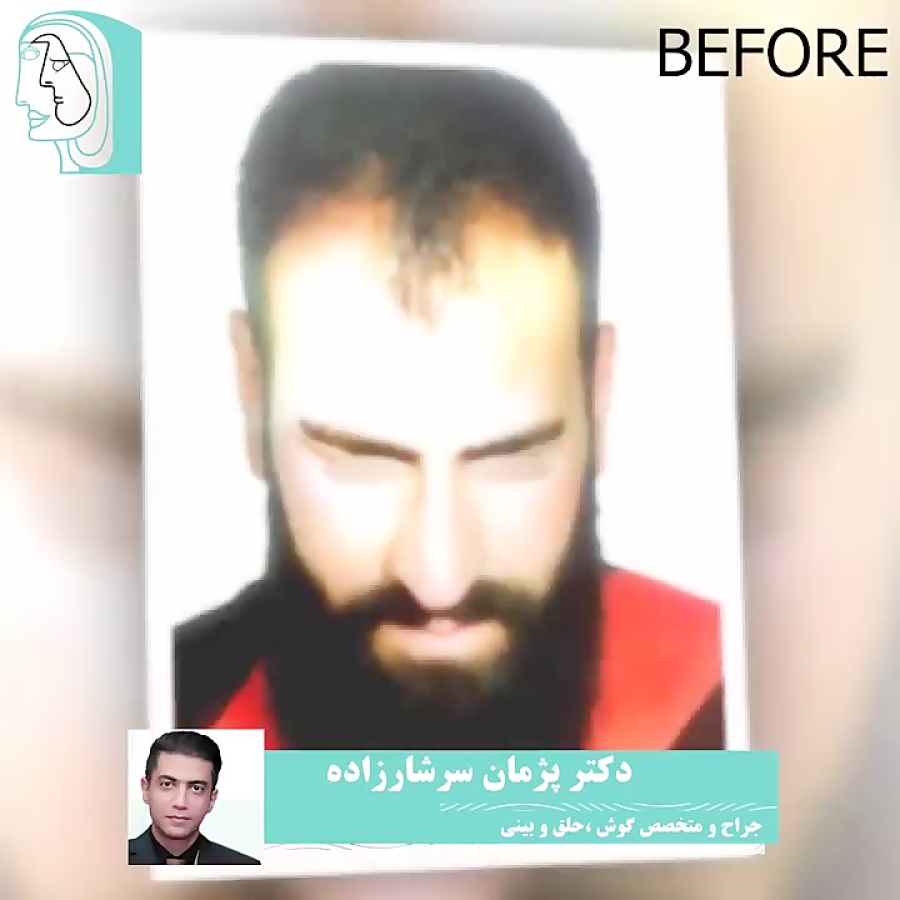قبل و بعد از جراحی بینی