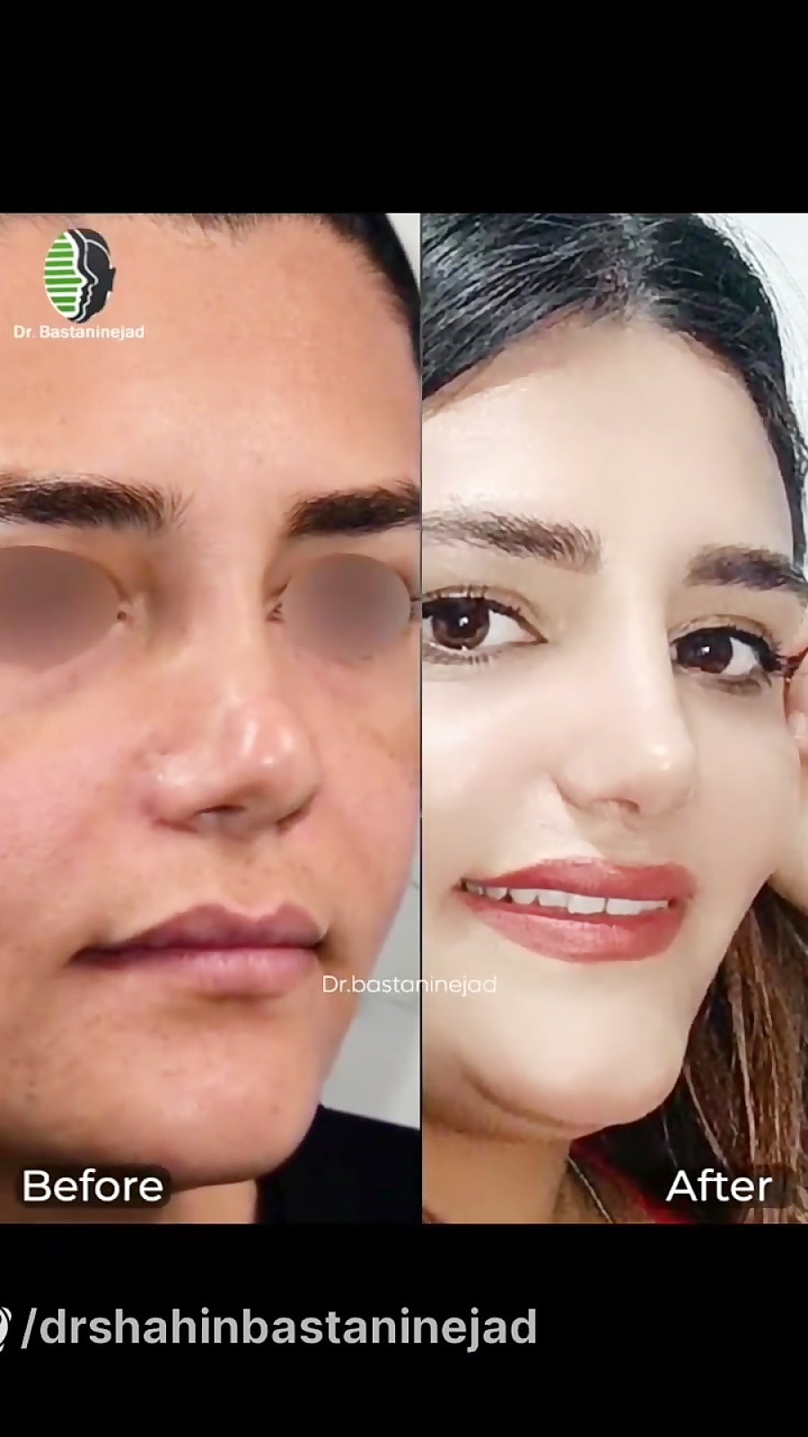 جراحی زیبایی بینی ترمیمی