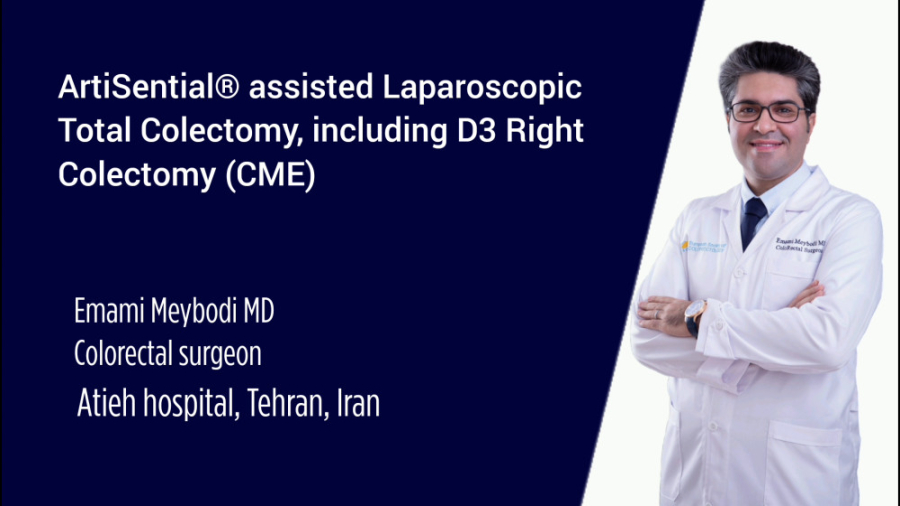 ArtiSential assisted Laparoscopic Total Colectomy (CME)