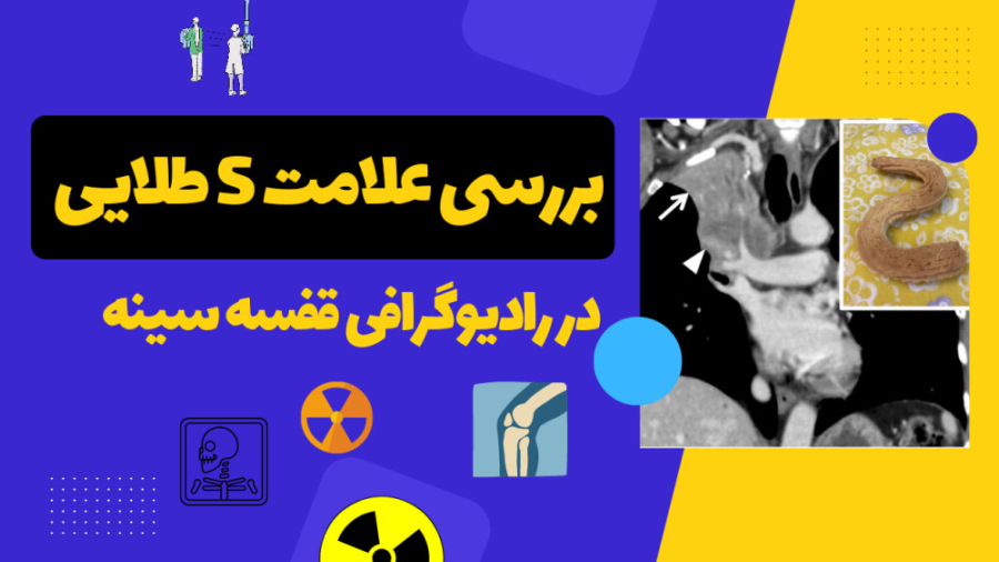 بررسی علامت S معکوس طلایی در رادیوگرافی قفسه سینه(Golden S Sign)