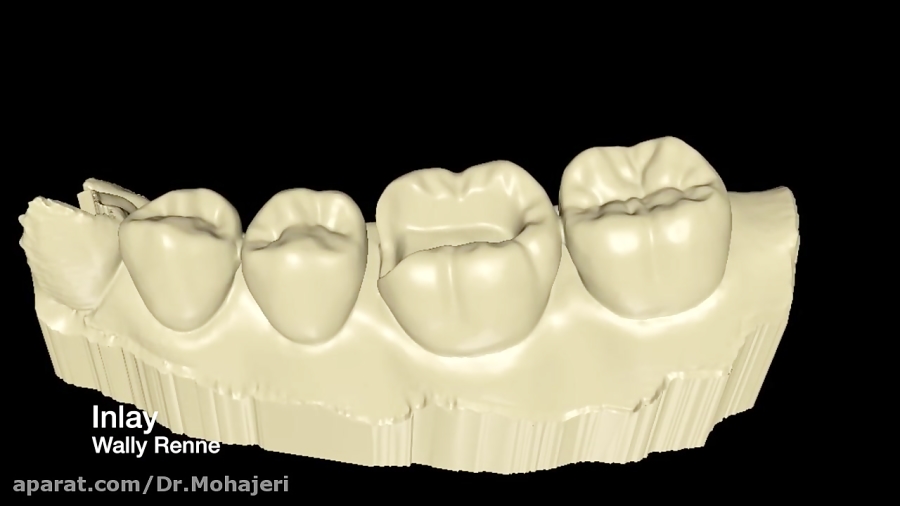 inlay, onlay, crownlay and crown
