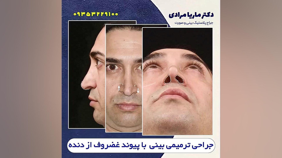 جراحی بینی ترمیمی با پیوند غضروف دنده دکتر ماریا مرادی