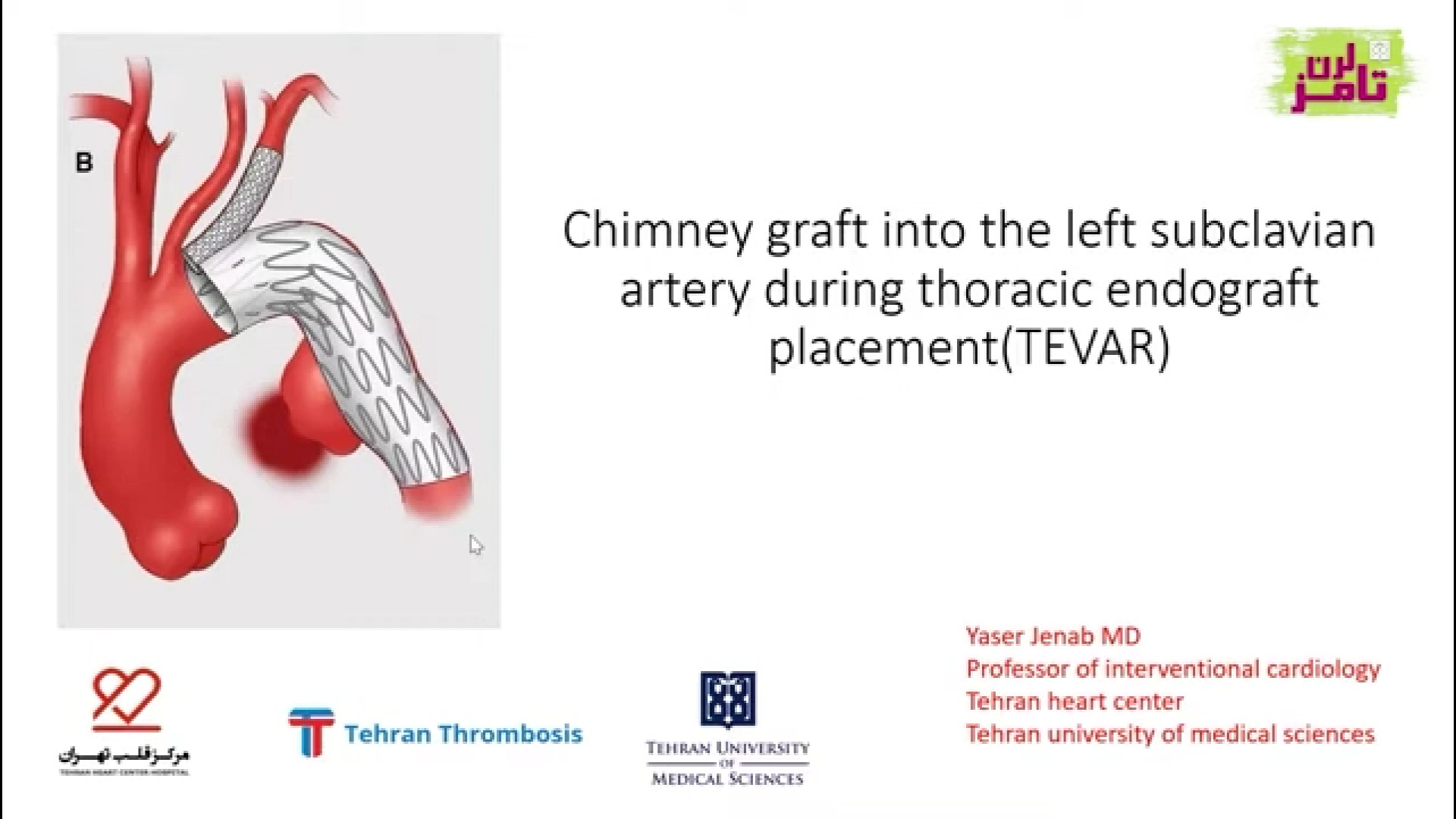 گرافت chimney در شریان ساب کلاوین چپ در پروسه TEVAR