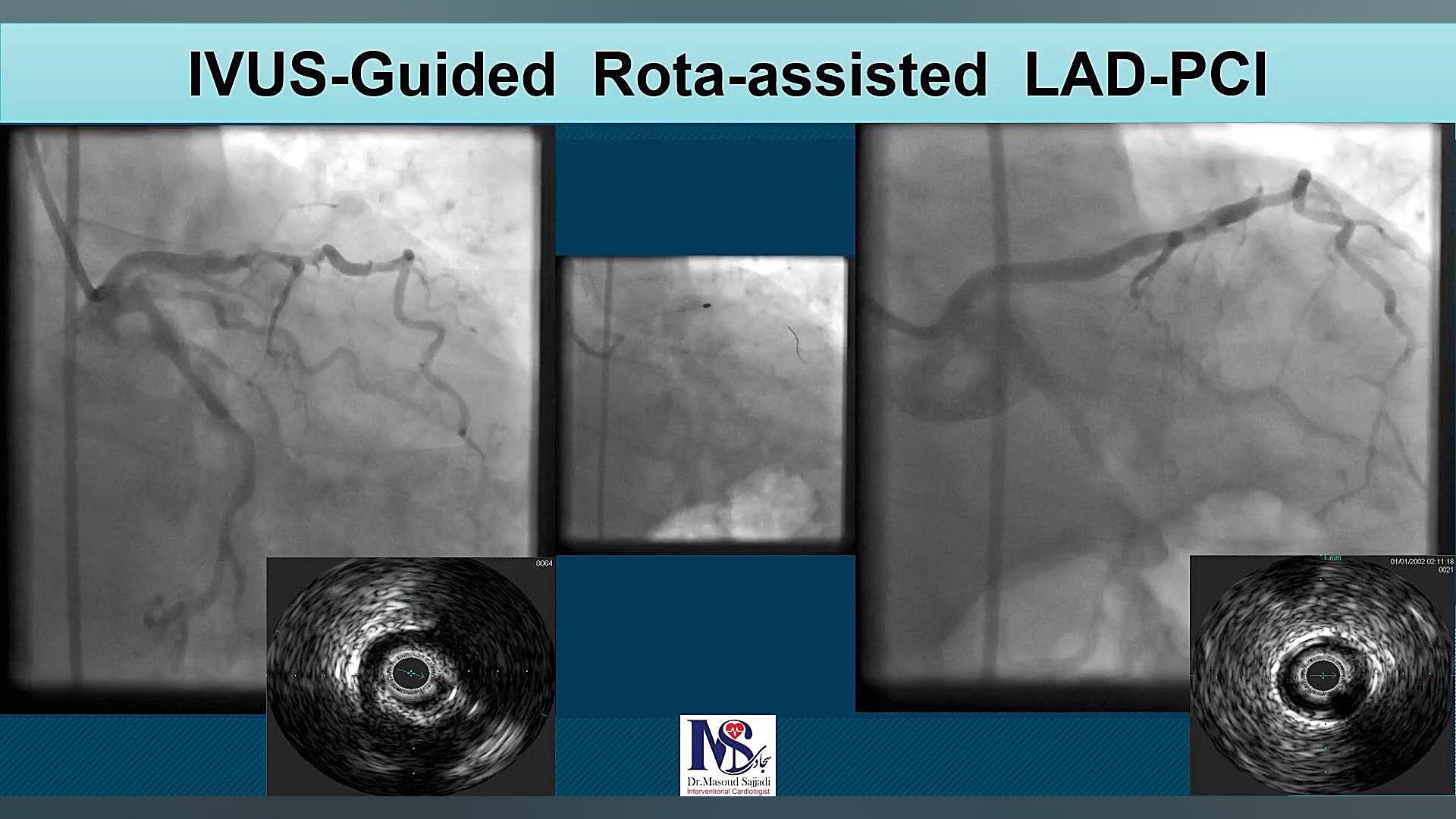 IVUS-Guided Rota-assisted LAD PCI