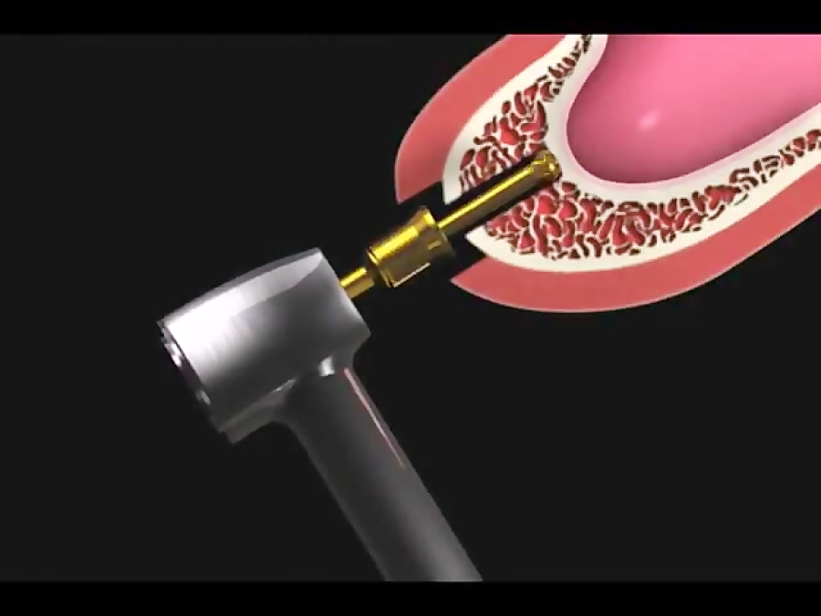 Neobiotech Sinus Lift Solution - SCA Kit (Procedure)