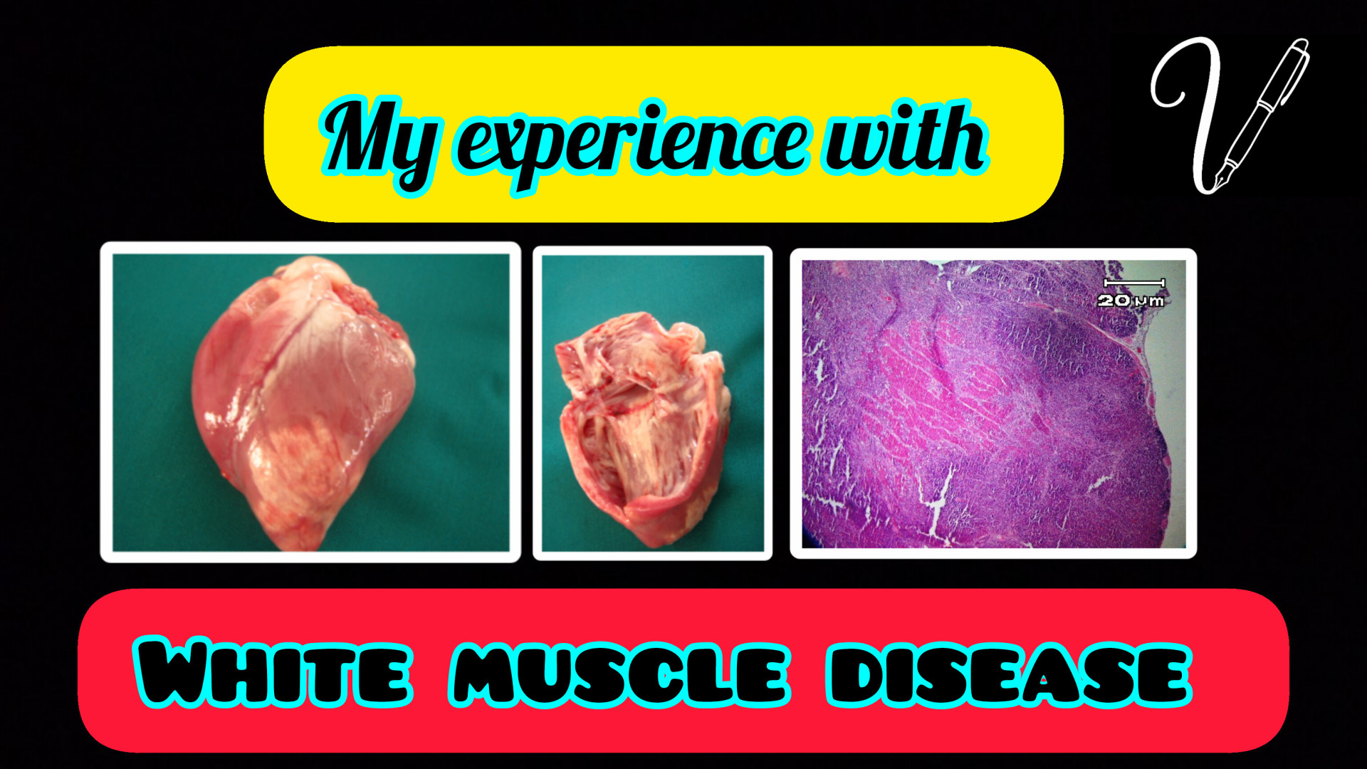 زخم معده (Gasteric ulcer)